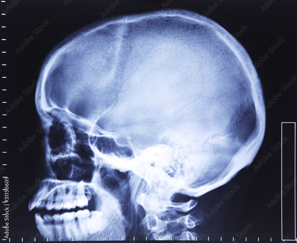 skull xray Stock Photo | Adobe Stock