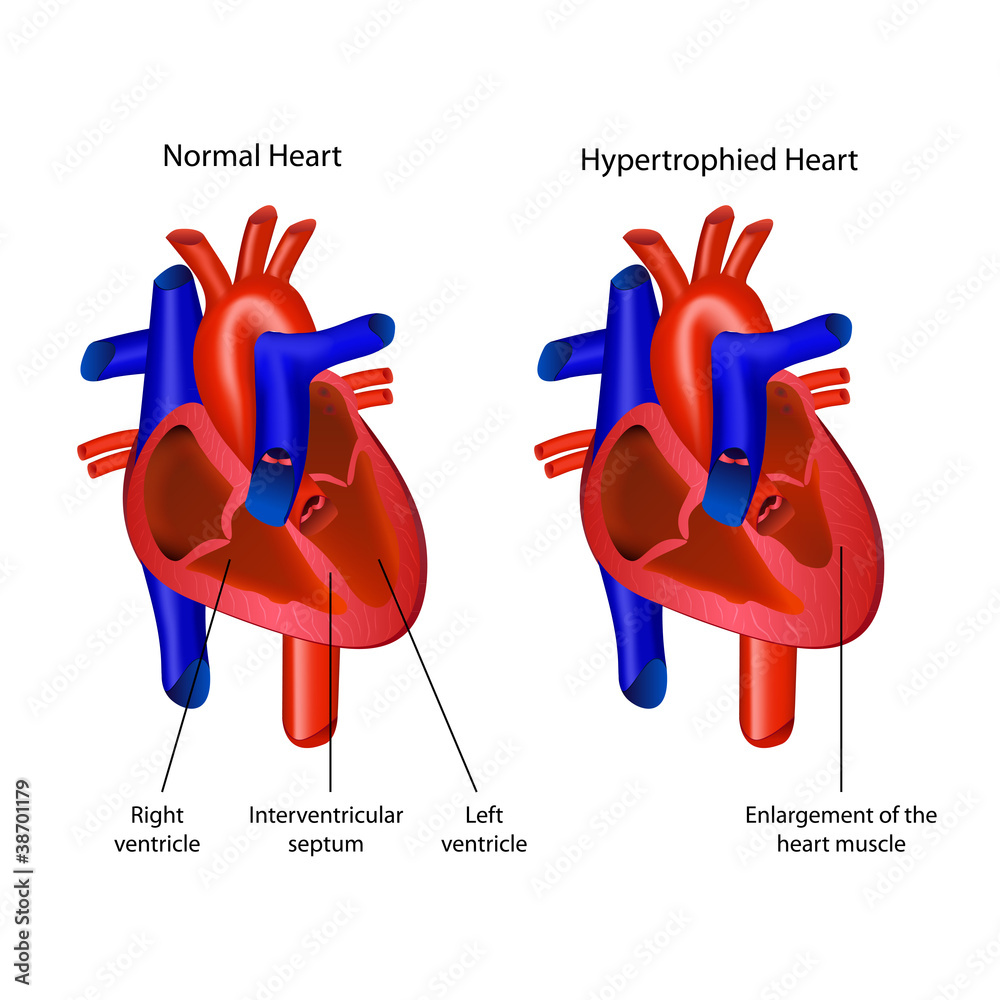 Ventricular Hypertrophy
