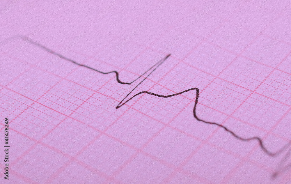 ecg graph, electrocardiogram ekg Stock Illustration | Adobe Stock