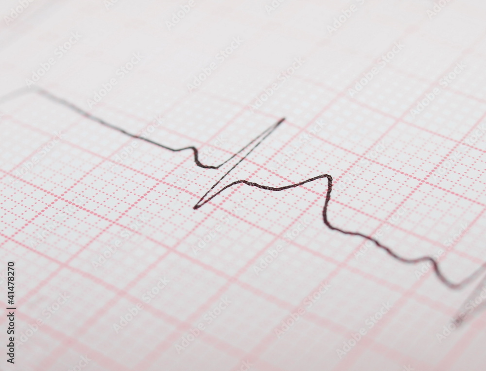 ecg graph, electrocardiogram ekg Stock Photo | Adobe Stock
