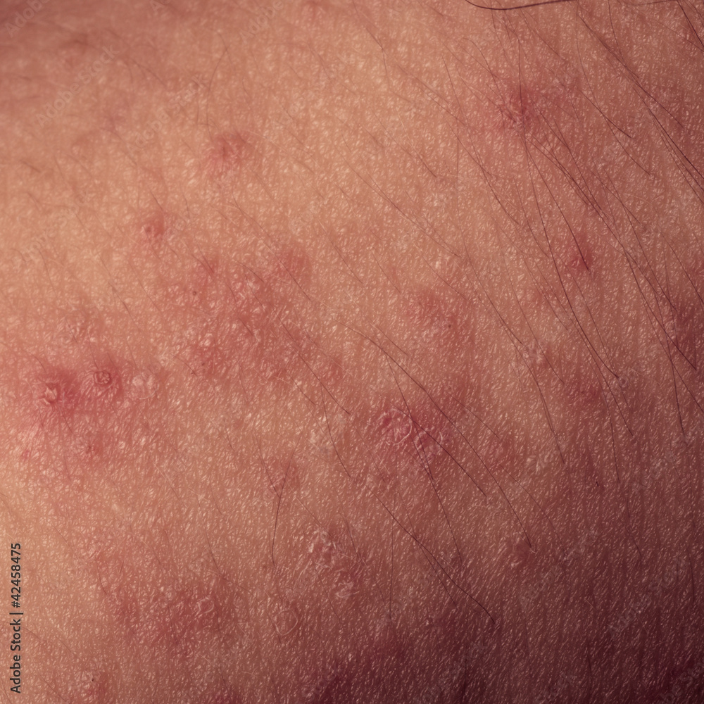 Foto de Stock eczema atopic dermatitis symptom skin texture | Adobe Stock