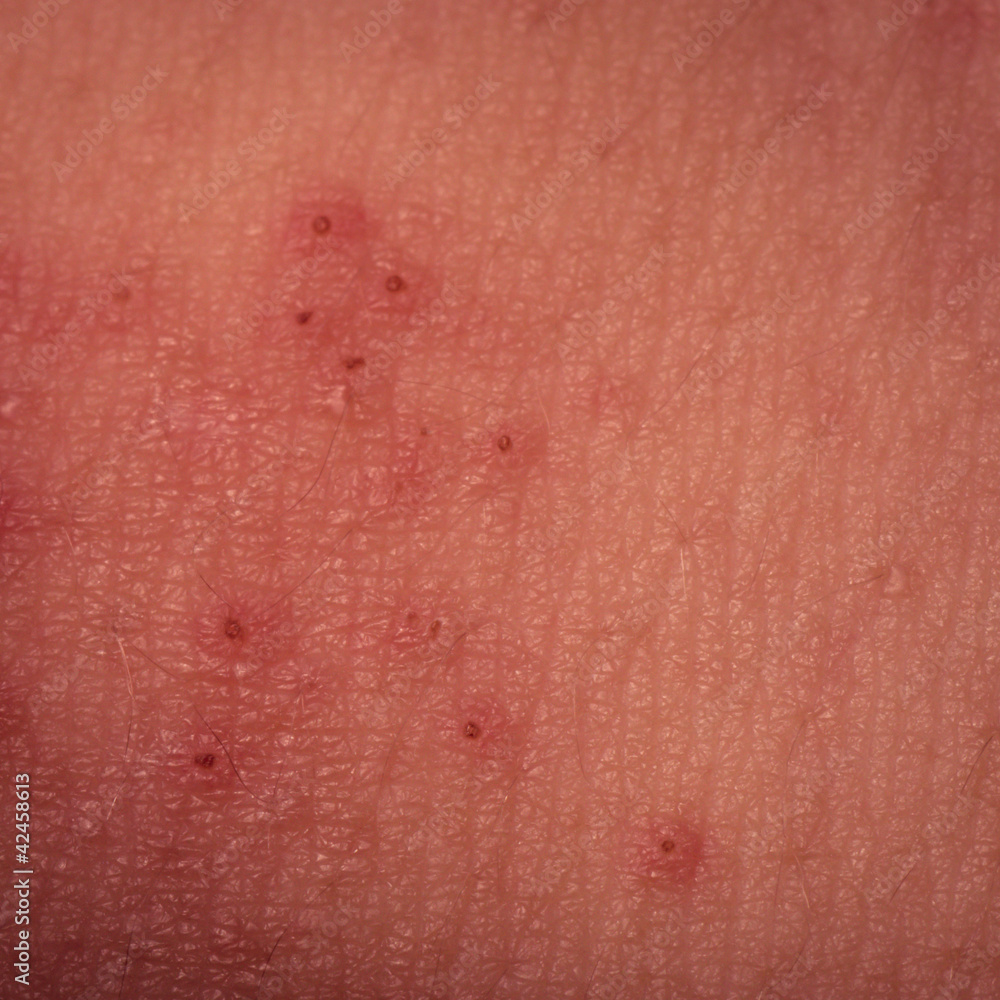 eczema atopic dermatitis symptom skin texture Stock Photo | Adobe Stock