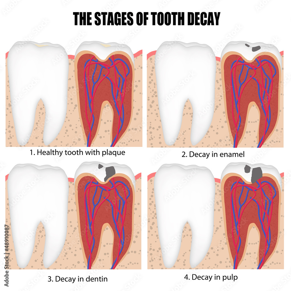 Diagram of tooth with caries stages Stock Vector | Adobe Stock
