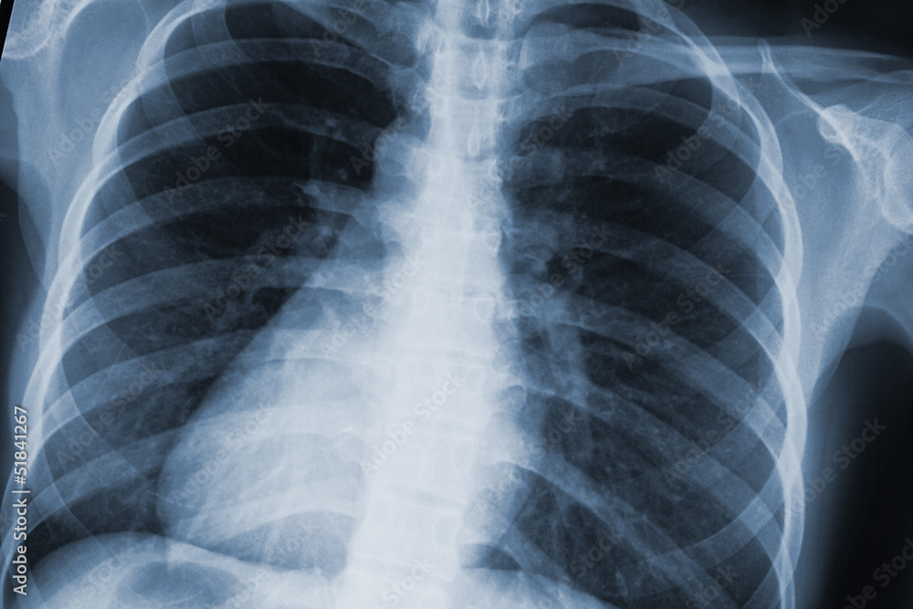 chest xray scan Stock Photo | Adobe Stock