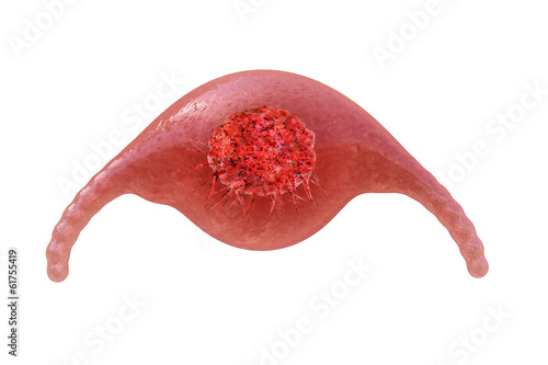 Gebärmutterhalskrebs - 3d Render – Stock-Foto | Adobe Stock