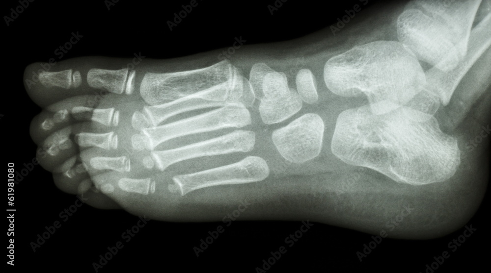 x-ray foot lateral : show normal child's foot Stock Photo | Adobe Stock