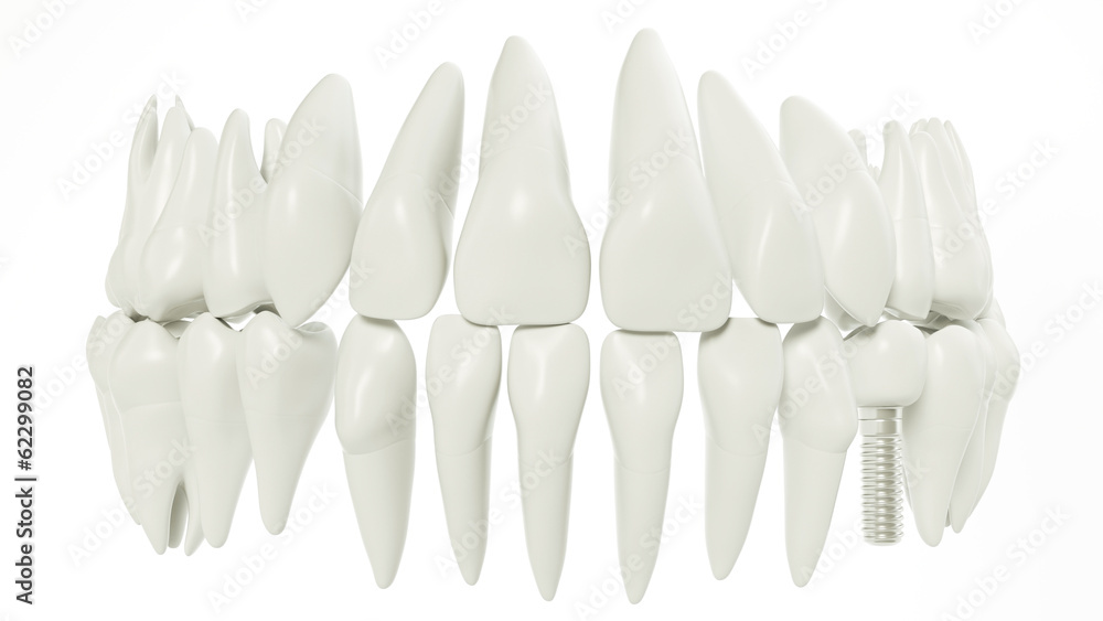 Stock-Illustration „Zahnreihe mit Implantat“ | Adobe Stock