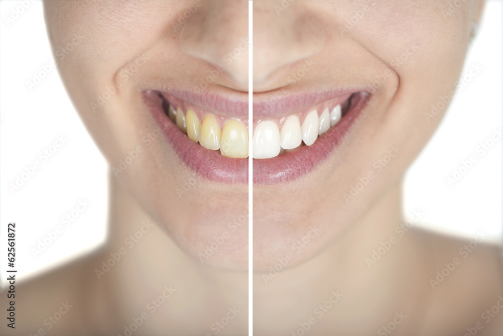 Bleaching before after Stock Photo | Adobe Stock