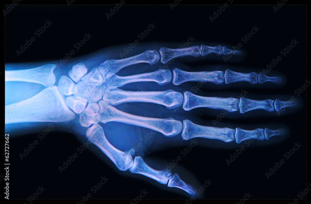 X-ray of Hand and fingers Stock Photo | Adobe Stock