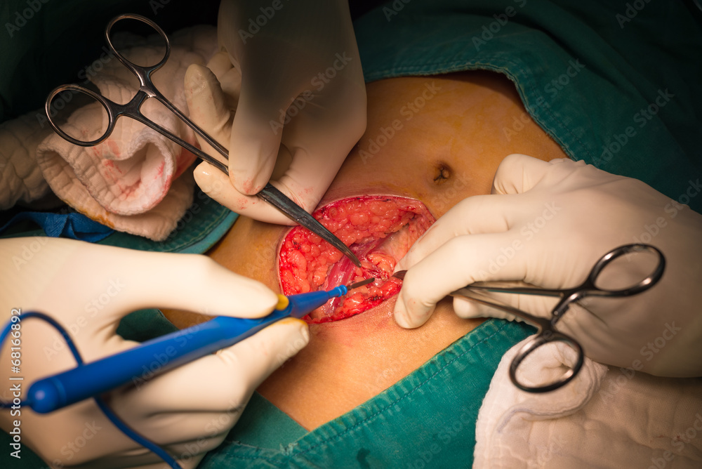 rupture appendicitis s/p explore laparotomy to appendectomy Stock Photo | Adobe Stock
