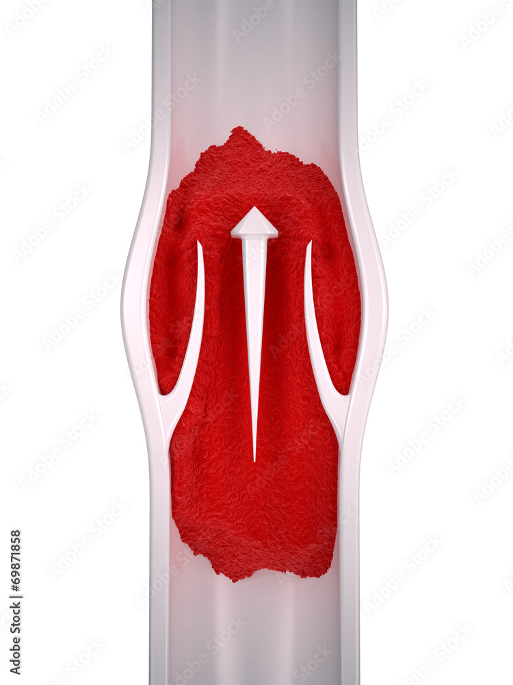 Thrombus - Anatomy of Deep Vein Thrombosis Stock Illustration | Adobe Stock