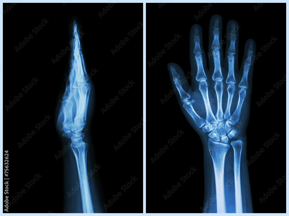 Foto X-Ray Hands ( front & side view ) : Normal human hands do Stock ...