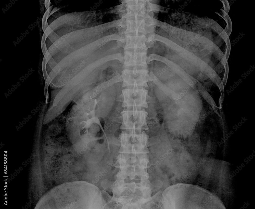 Film IVP, 5 minutes after injection of contrast media, of a lymphoma ...