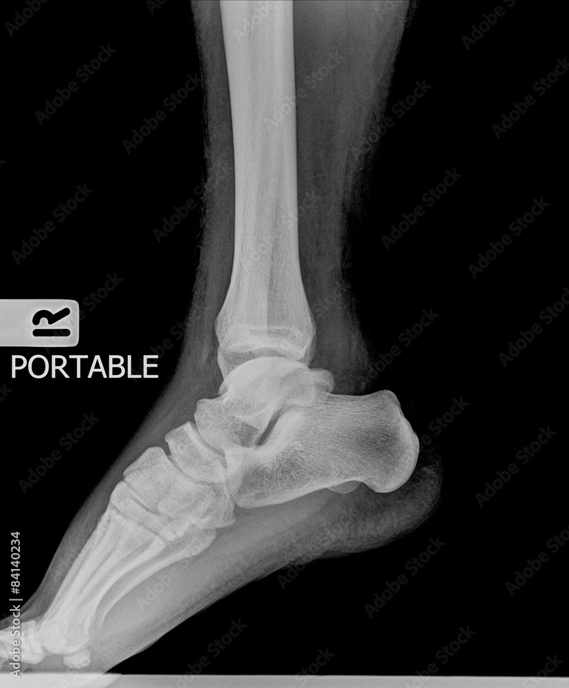 X-ray image of an ankle in the lateral position Stock Photo | Adobe Stock
