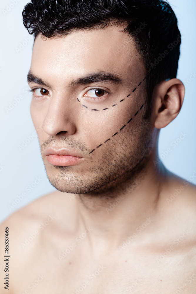 The man on the face is marked with guides before surgery filling wrinkles, crow's feet ...