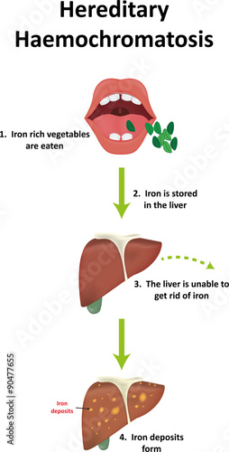 Hereditary Haemochromatosis Pathophysiology Stock Illustration | Adobe ...