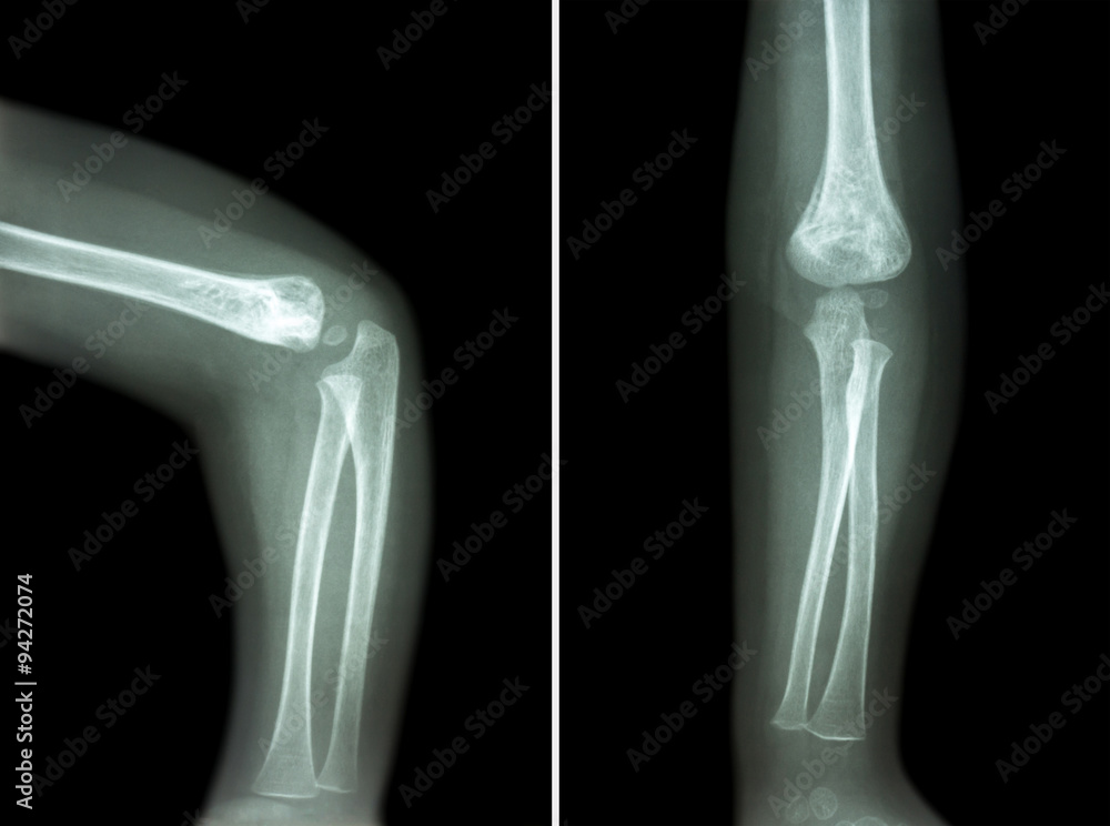 Film x-ray of child 's elbow ( normal child 's elbow ) ( Side and front ...