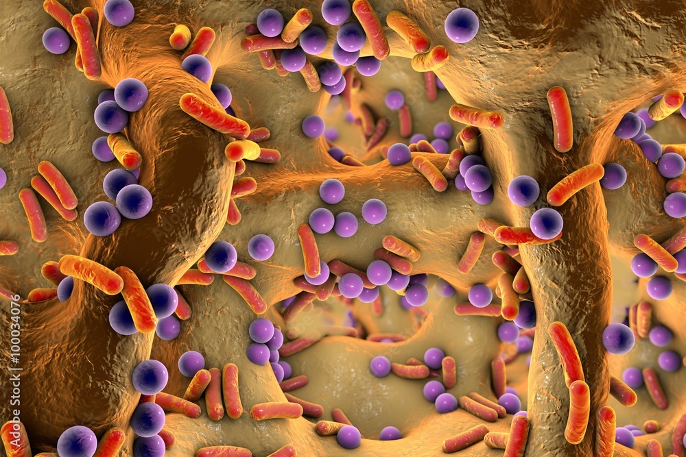 Ilustracja bez tantiem: Spherical and rod-shaped bacteria inside bone ...