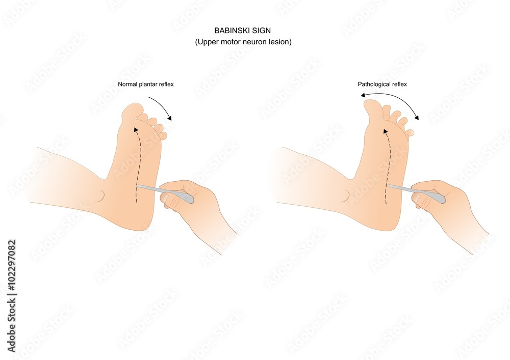 test for a possible motor neuron lesion: the babinski sign Stock Vector ...