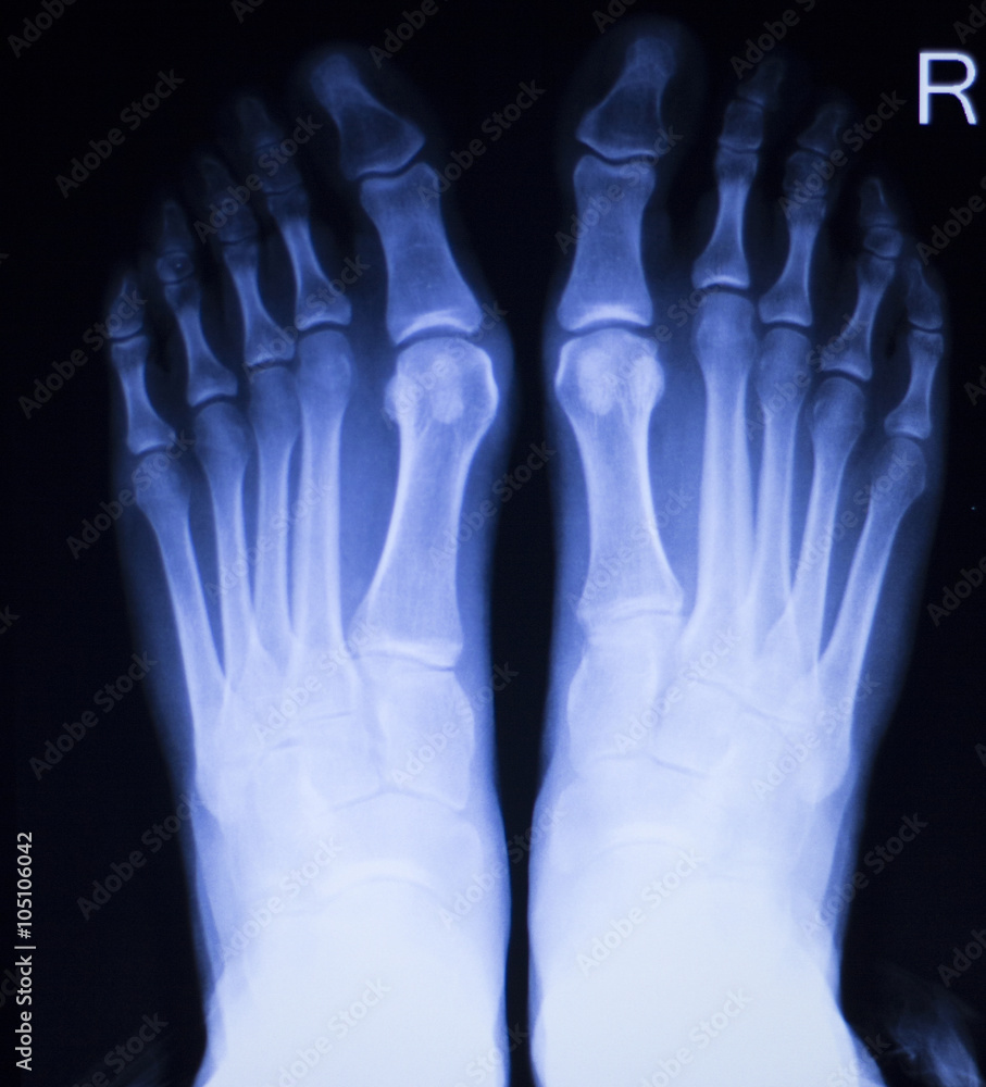Foot and toes injury xray scan Stock Photo | Adobe Stock