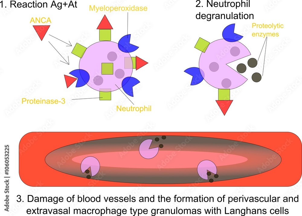Pathogenesis of Wegener's syndrome Stock Vector | Adobe Stock