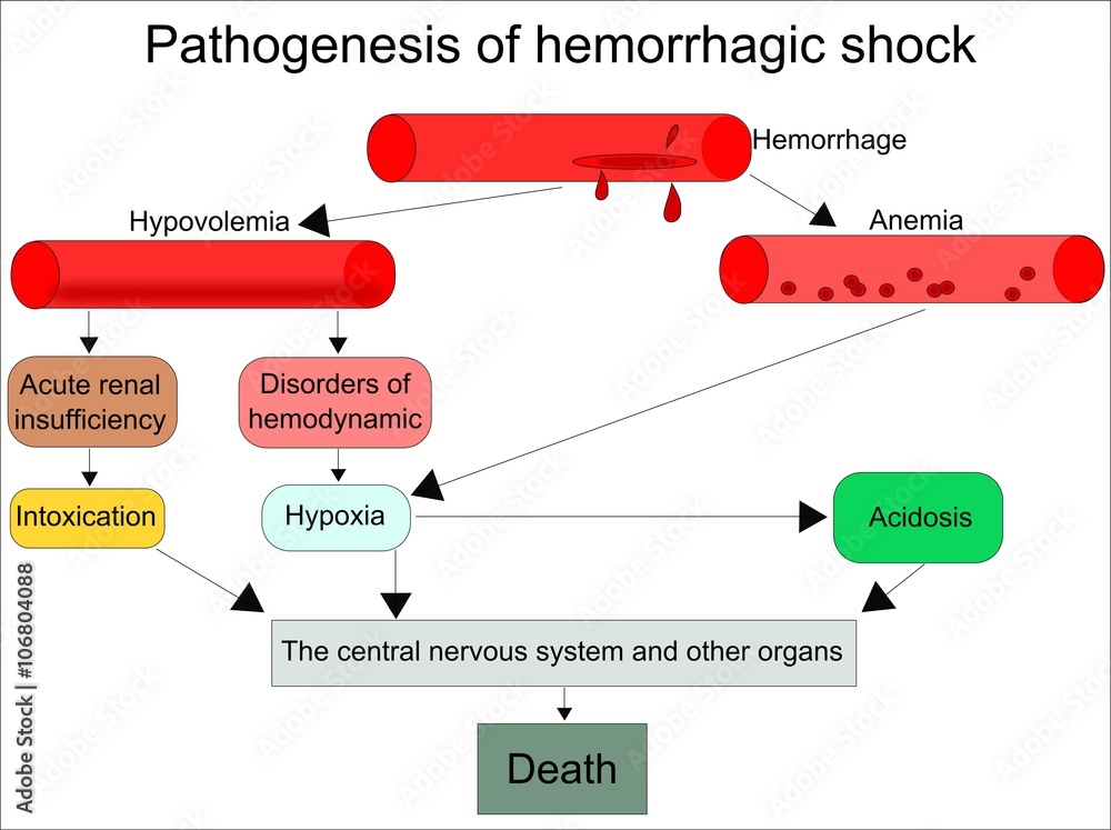 Schematic pathogenesis of hemorrhagic shock Stock Vector | Adobe Stock