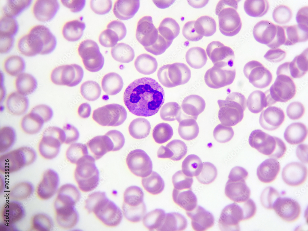 Neutrophil cell (white blood cell) in peripheral blood smear, Wright ...