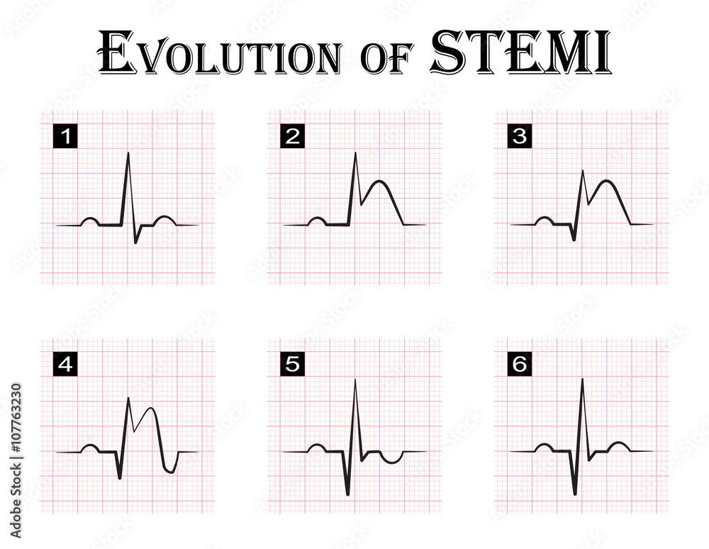 ECG of evolution ( step by step ) of STEMI ( ST elevation myocardial ...