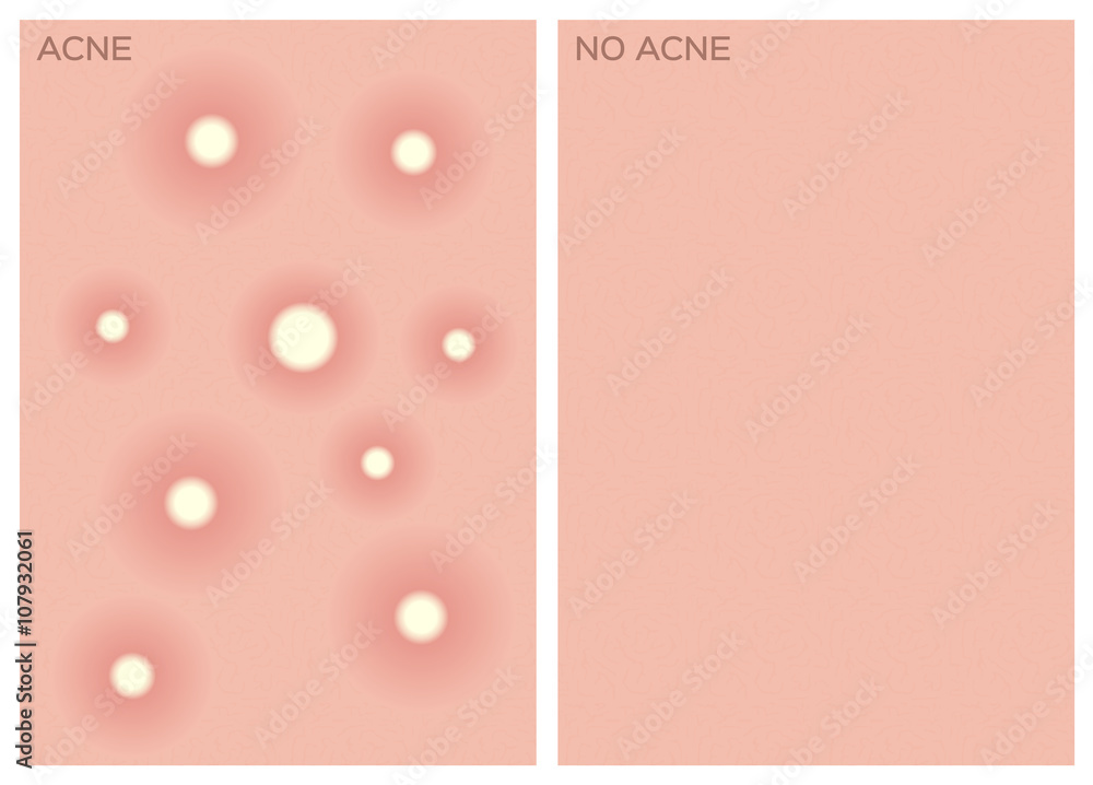 acne , before and after texture , vector Stock Vector | Adobe Stock
