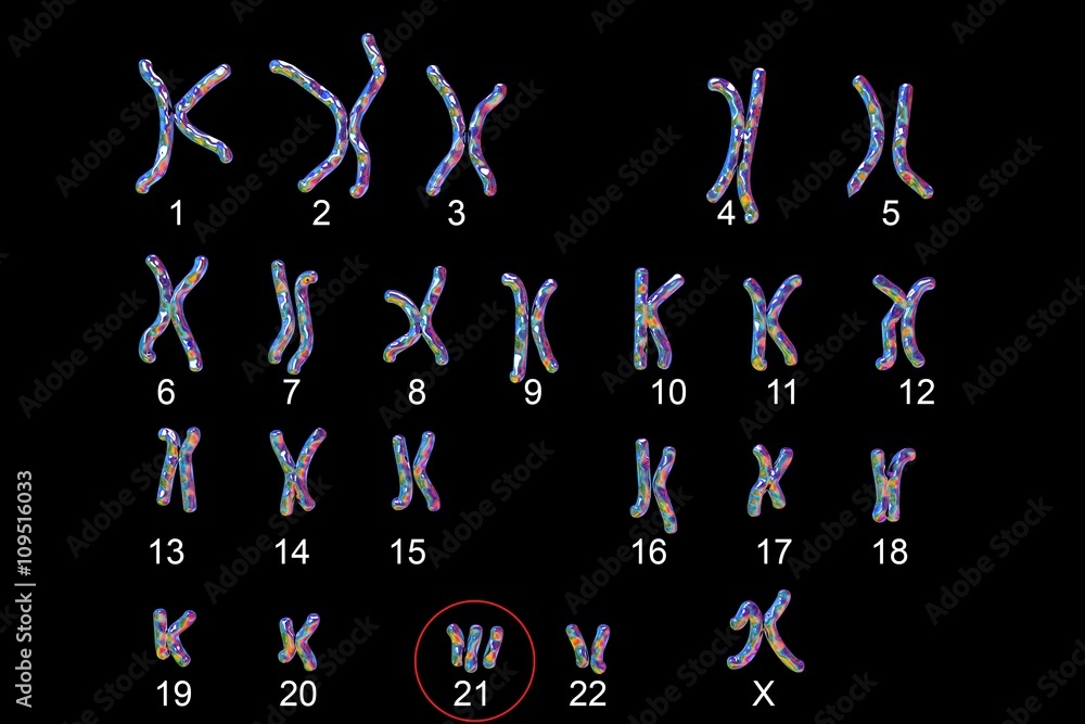 Down-syndrome karyotype, female, labeled, isolated on black background. Trisomy 21. 3D ...