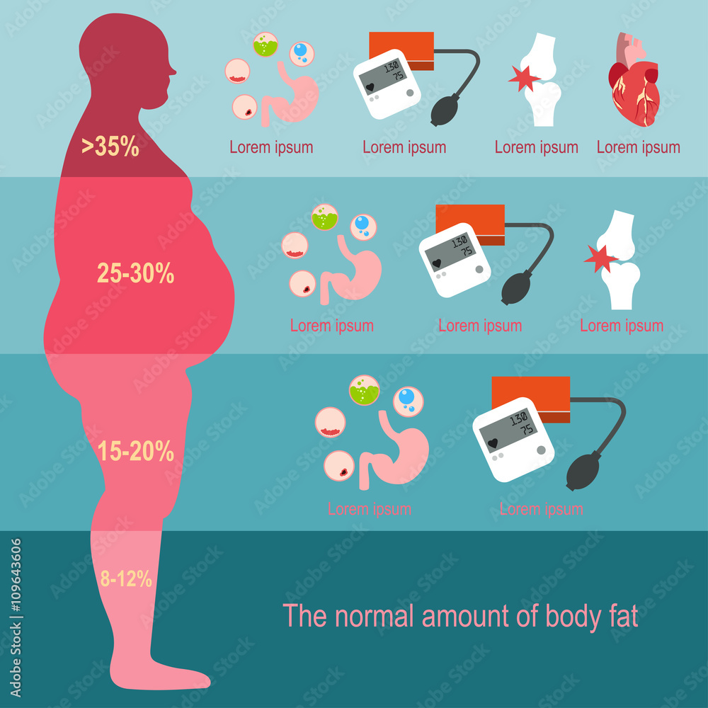 Obesity man. The degree of obesity. Vector illustration. The ...