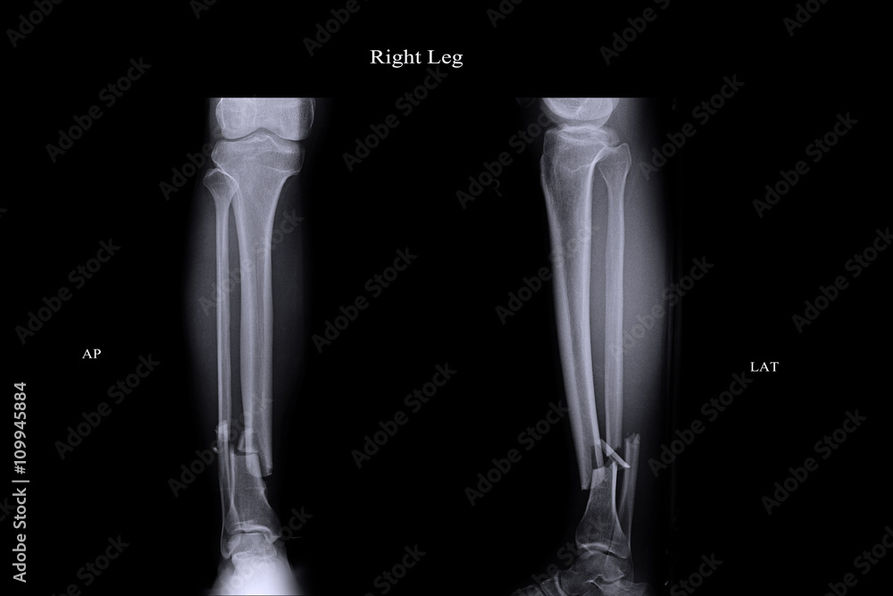 closed fracture left leg tibia and fibula Stock Photo | Adobe Stock