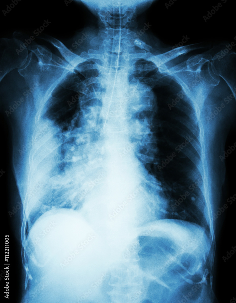 Lung cancer . Film chest x-ray show right lung mass , wide mediastinum ...