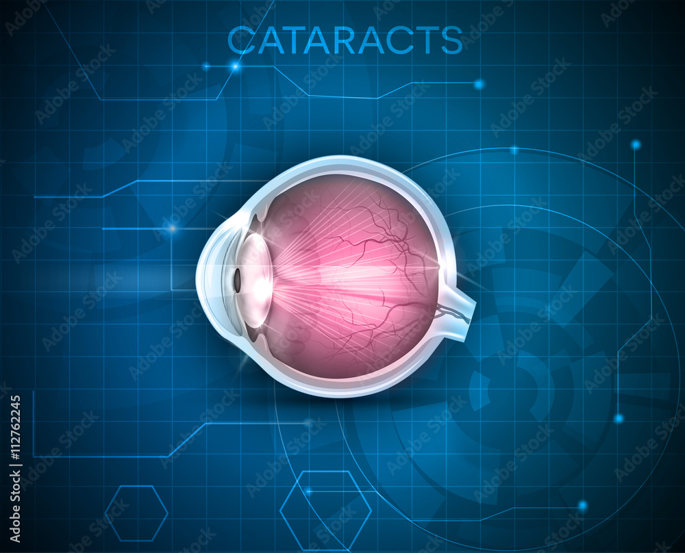 Cataracts. Human vision disorder, detailed anatomy of cataracts and ...