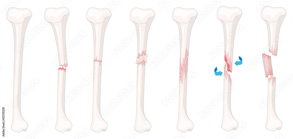 Different stages of leg fracture Stock Vector | Adobe Stock