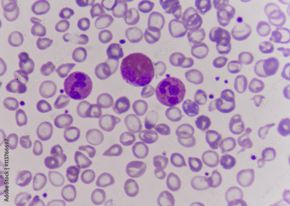 Neutrophil cell (white blood cell) in peripheral blood smear, Wr Stock ...