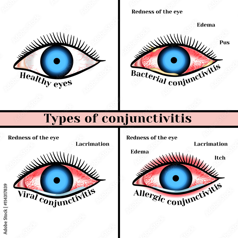 Conjunctivitis types. Inflammatory diseases of eyes. Stock Vector ...