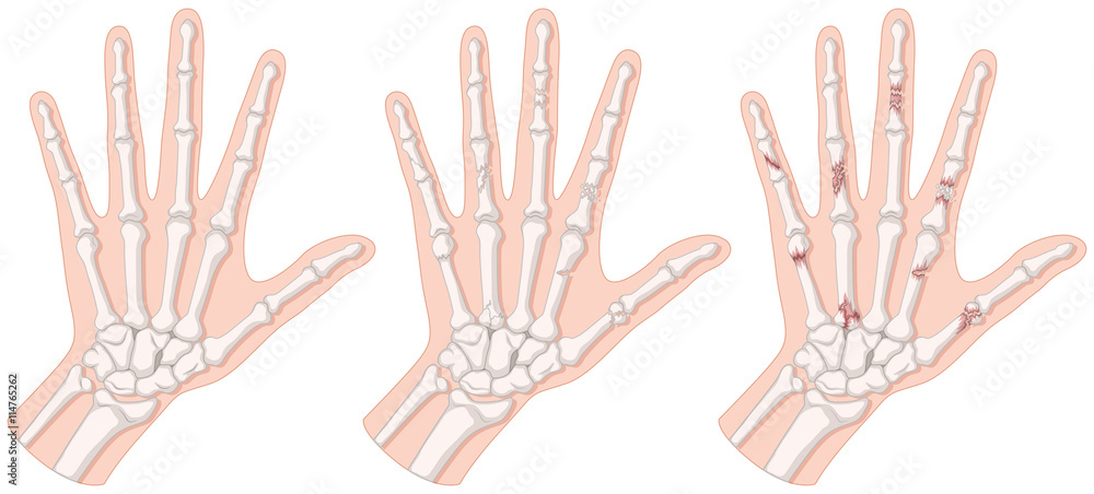 Diagram showing hand fracture Stock Vector | Adobe Stock