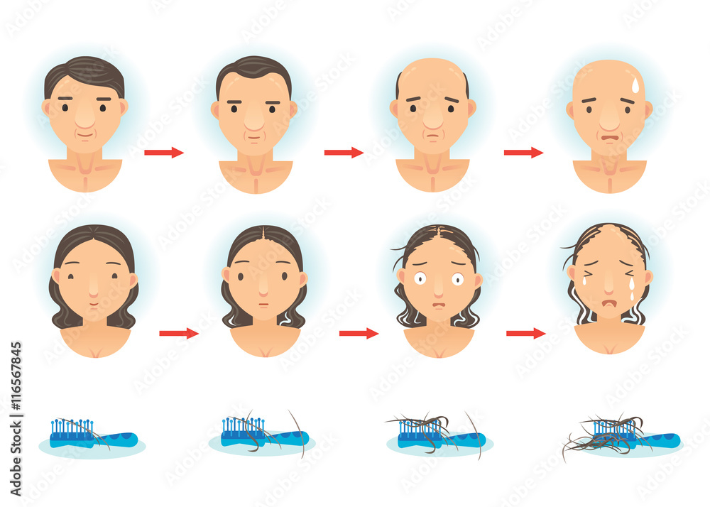 Hair Loss/The process of hair loss. Cartoon vector illustration Stock ...