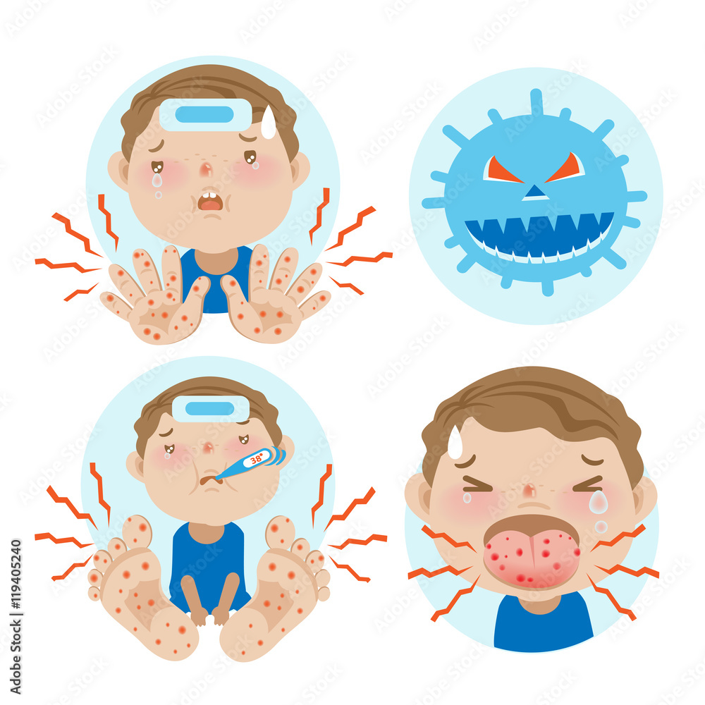 HFMD children infected. hand foot and mouth disease.Cartoon vector ...