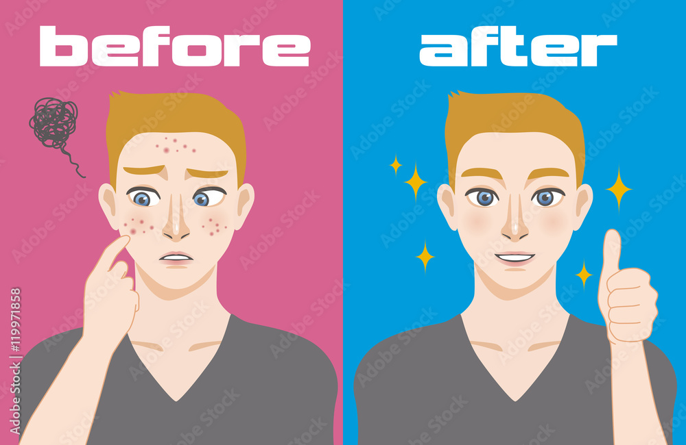young boy acne treatment before and after, facial cleansing foam, men's ...