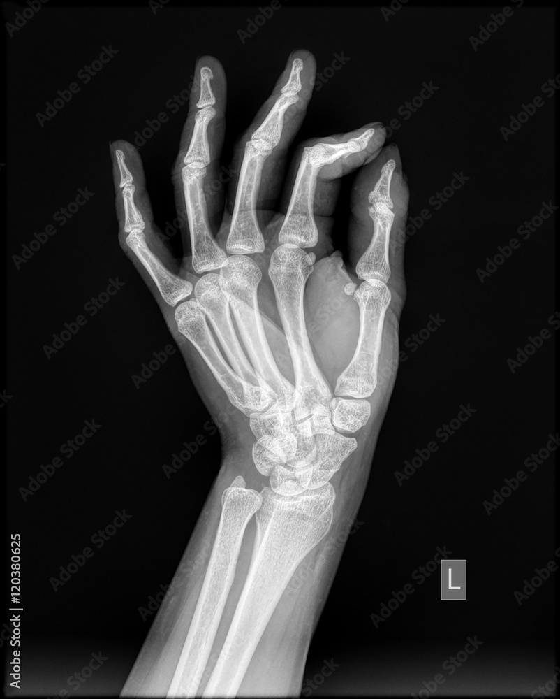 Hand xray of human in side view Stock Photo | Adobe Stock