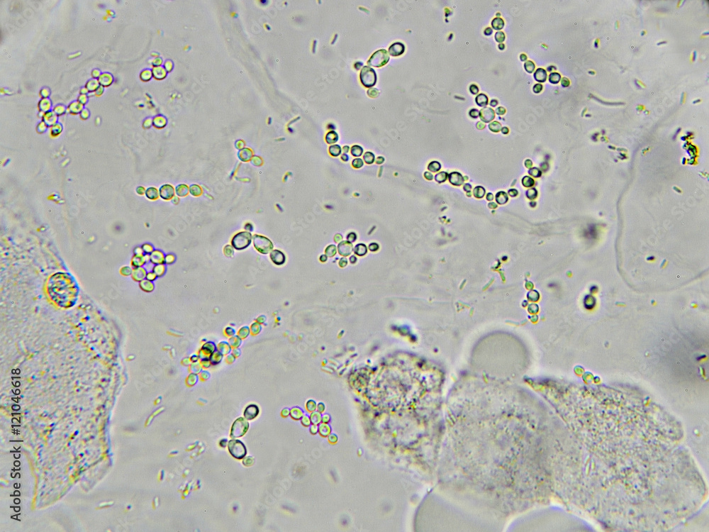 Budding yeast cells in patient urine (urinary tract infections ...