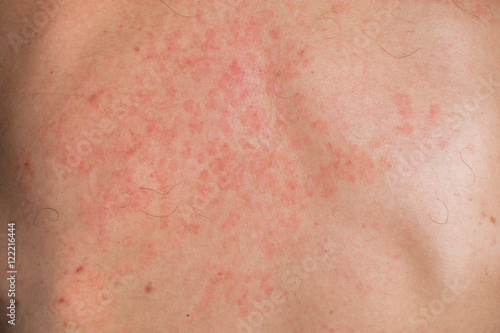 Skin fungus on his back. Red spots on the backs of men. Mold. Photo ...