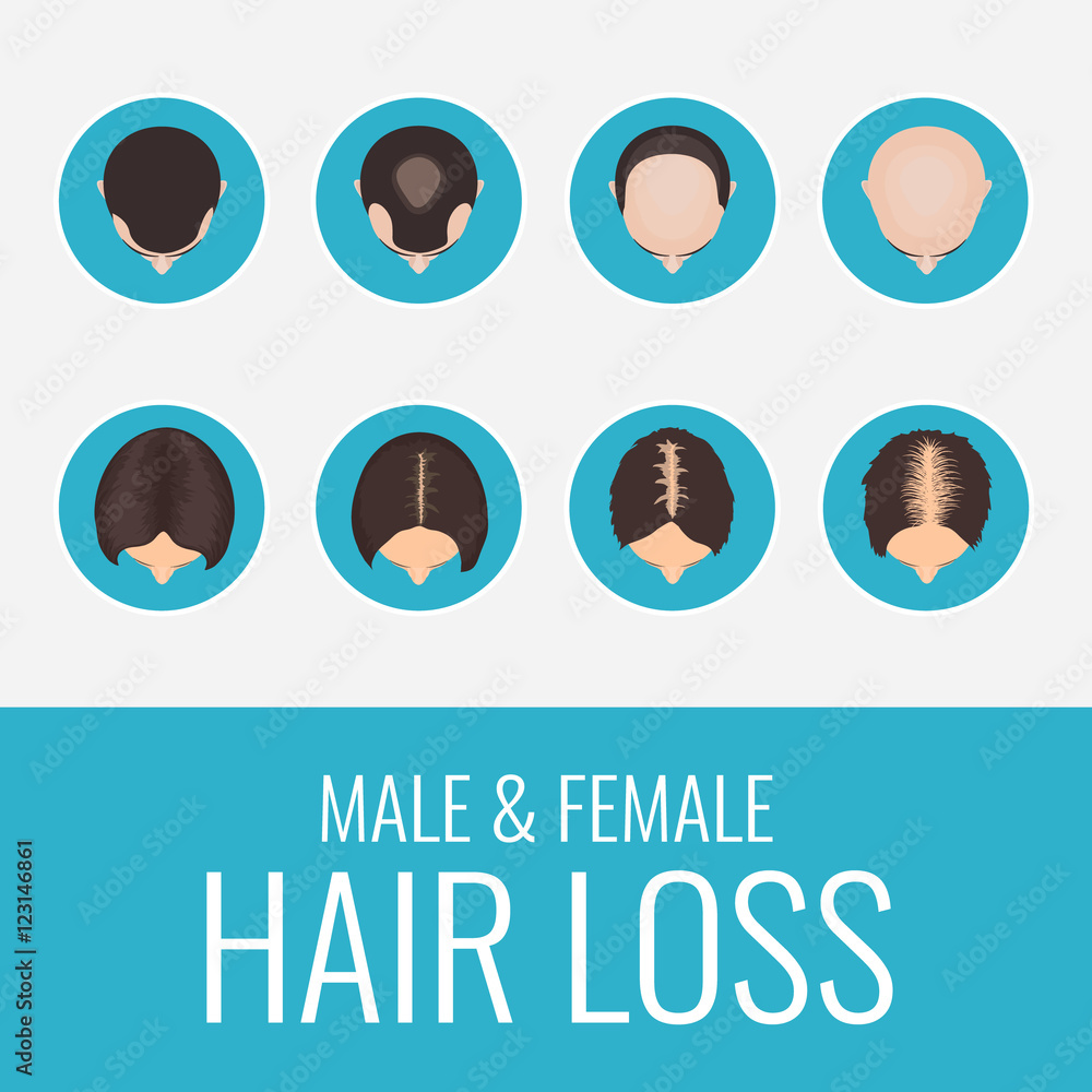 Vector de Stock Male and female pattern hair loss set. Stages of ...