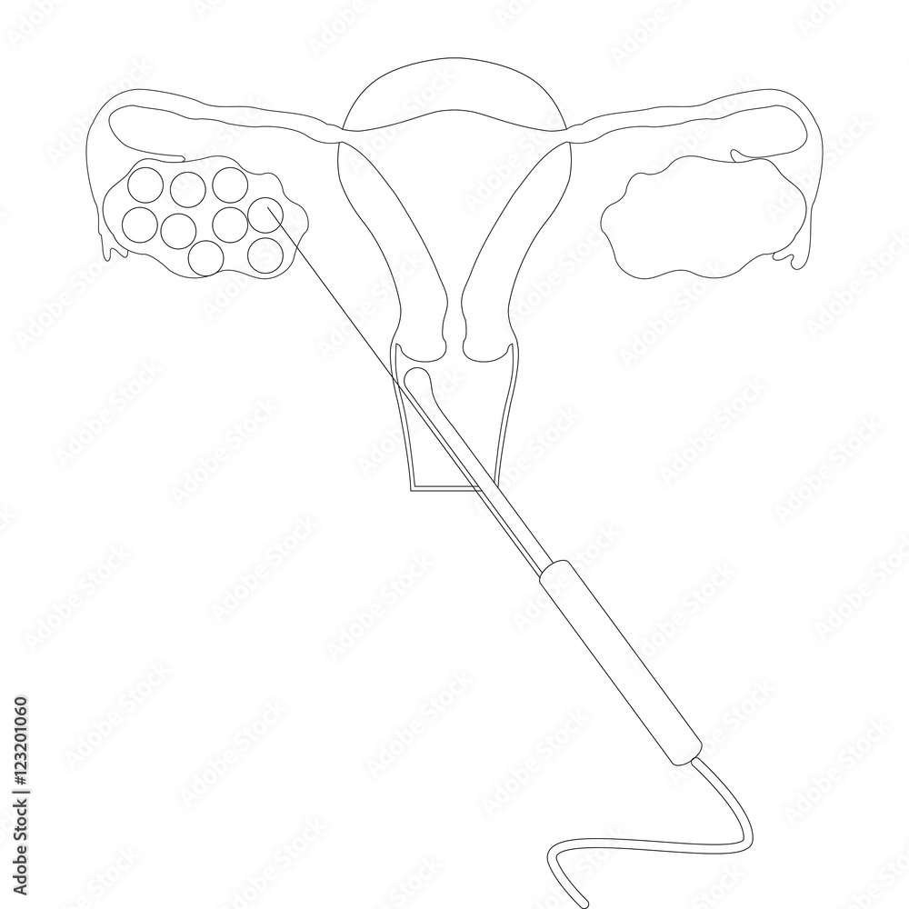 In vitro fertilization, egg pick up (aspiration), puncture of follicles ...