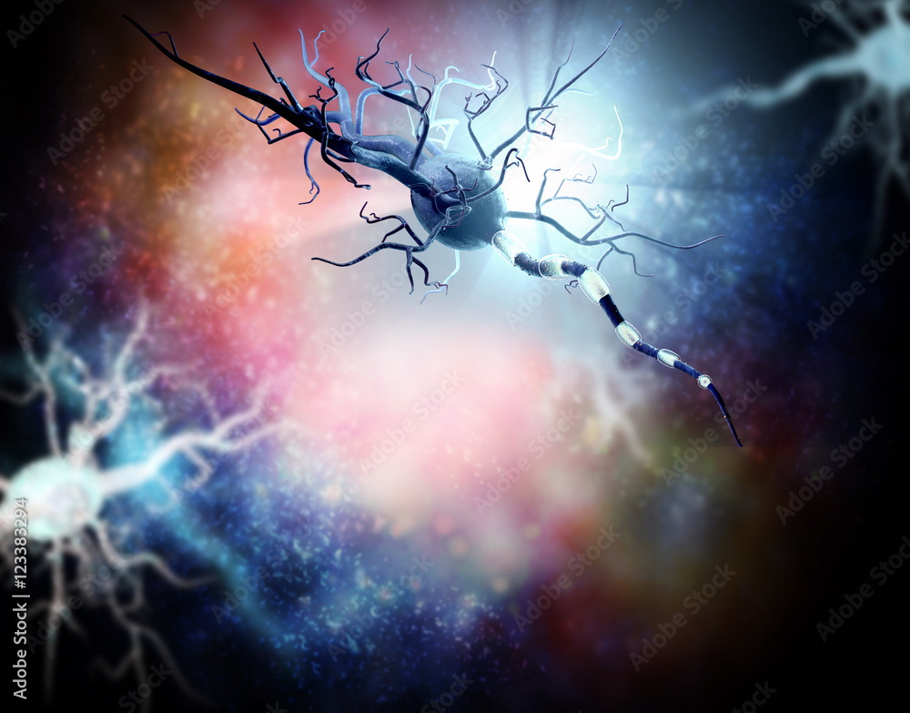 Damaged nerve cells, concept for neurodegenerative and neurological ...