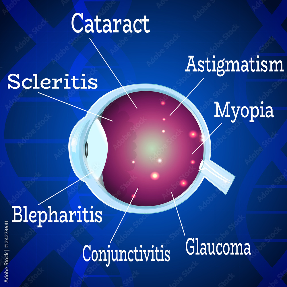 Vetor Human eye diseases anatomy structure.Medical infographics for ...