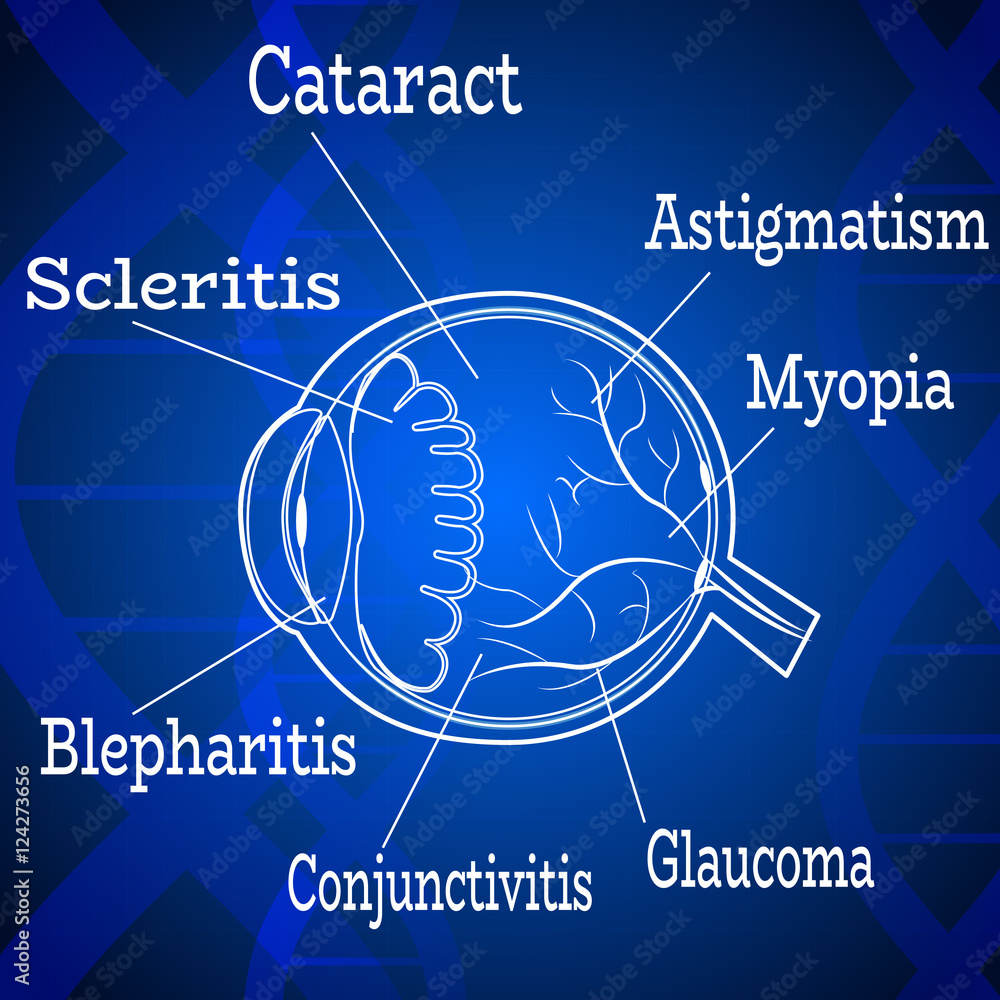 Vetor Human eye diseases anatomy structure.Medical infographics for ...