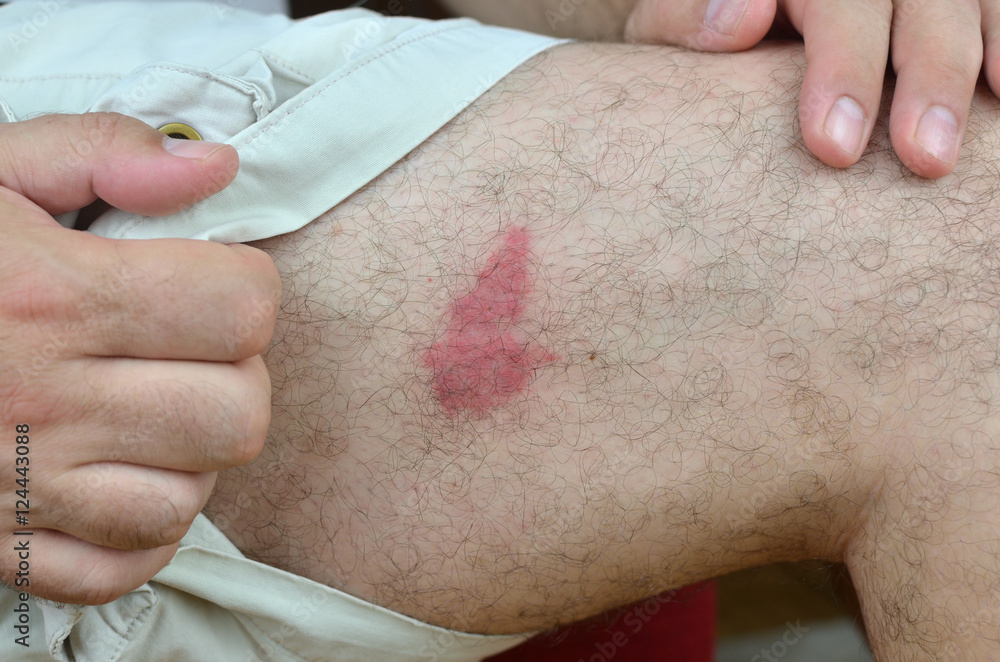 Redness of skin on a leg as a consequence of an unknown insect bites ...